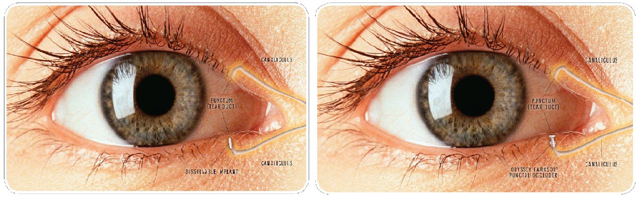Punctum Plugs – AIVIMED GmbH medical optics